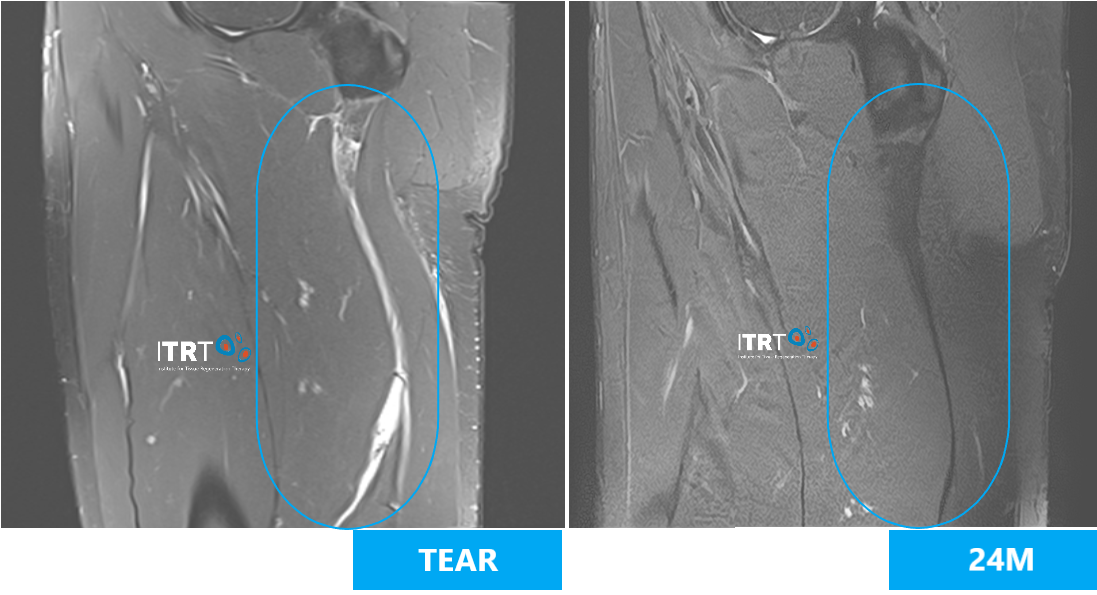 Hamstring tear - Healing treatment in record time
